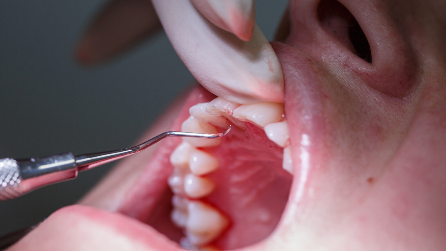 Periodontitis: Symptoms, Causes, and Treatments | Body Expert