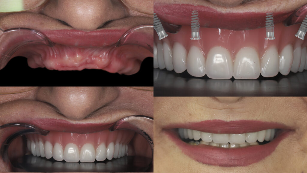 Full Mouth Dental Implants: Benefits, Solutions & Long-Term Care for ...