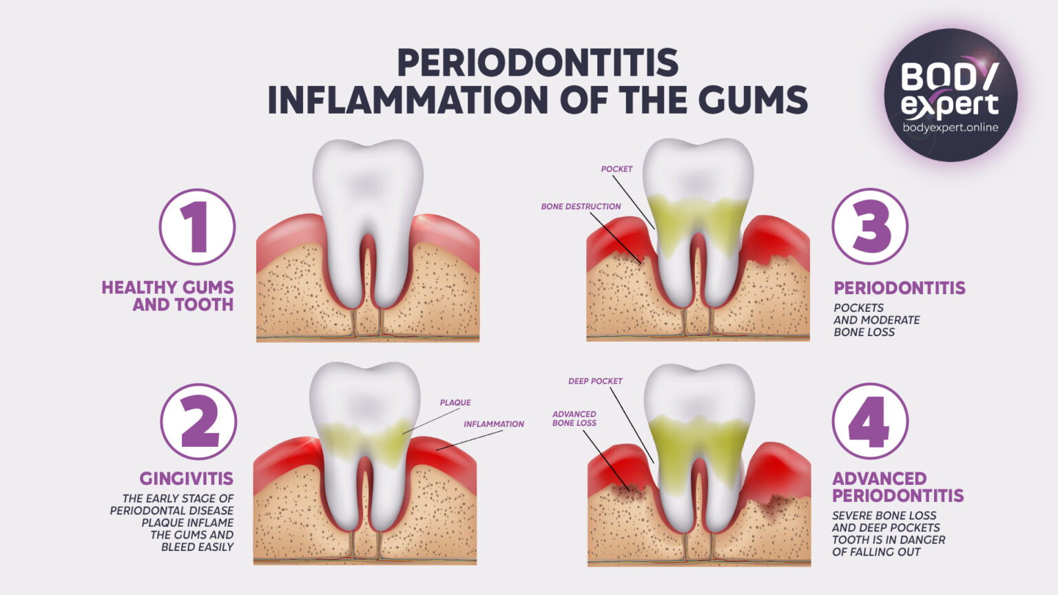 Periodontitis: Symptoms, Causes, and Treatments | Body Expert