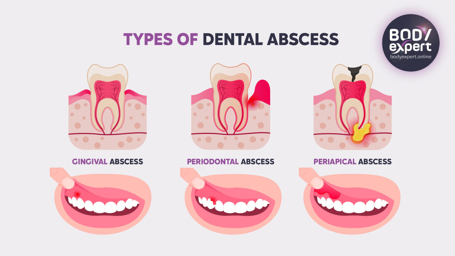 Periodontitis: Symptoms, Causes, and Treatments | Body Expert