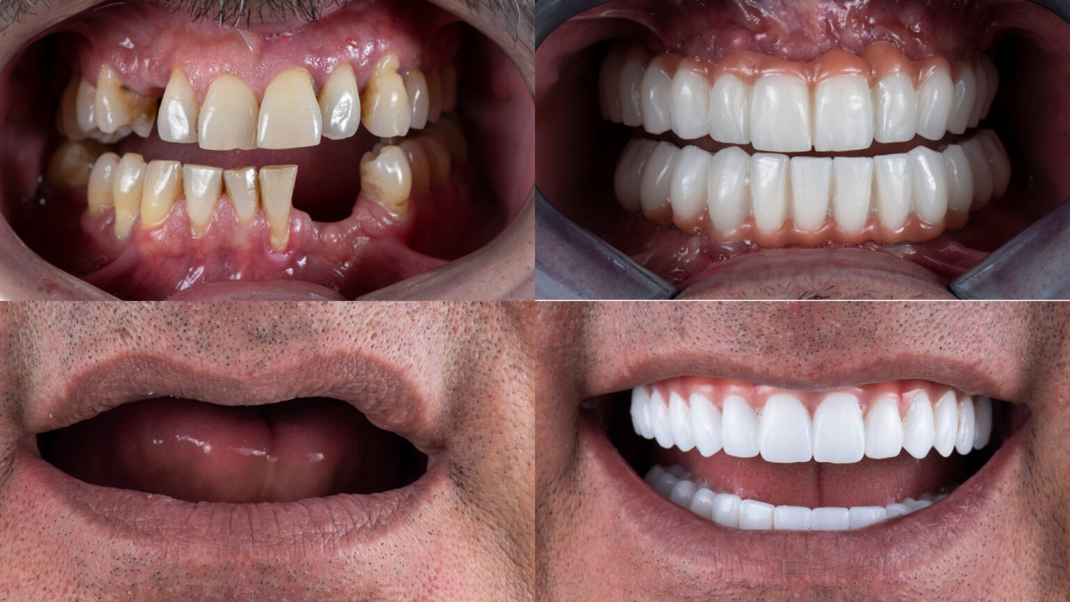 Full Mouth Dental Implants: Benefits, Solutions & Long-Term Care for ...
