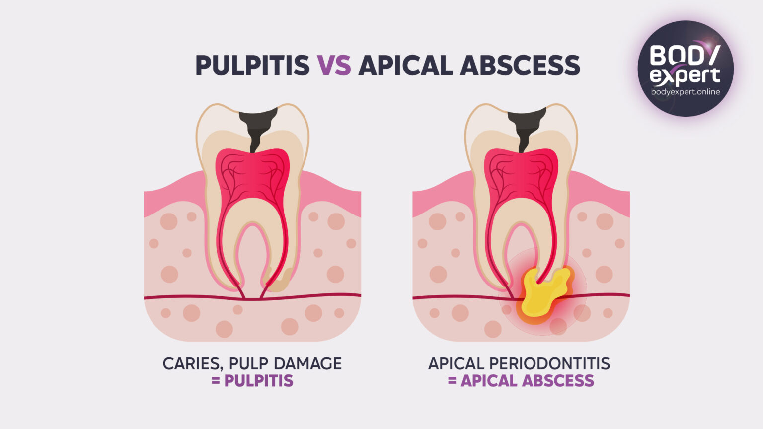 Periodontitis: Symptoms, Causes, and Treatments | Body Expert