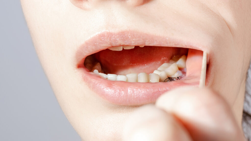 Periodontitis: Symptoms, Causes, and Treatments | Body Expert