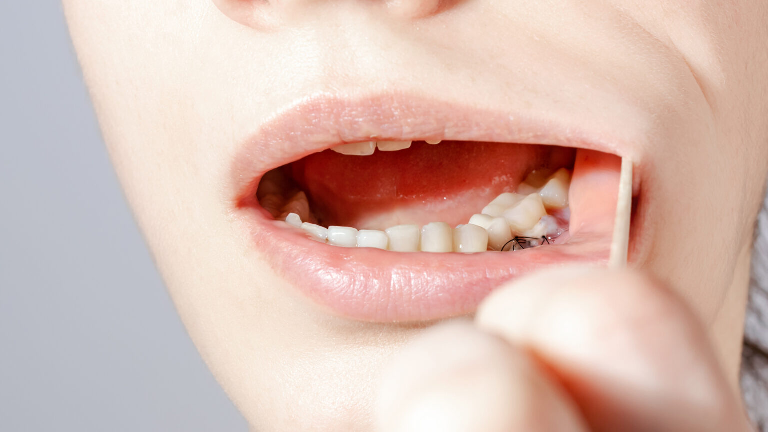 Periodontitis: Symptoms, Causes, and Treatments | Body Expert