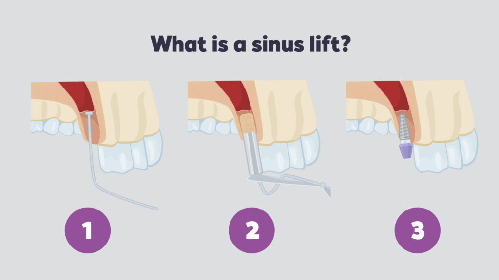 Sinus lift in Turkey: everything you need to know | Body Expert