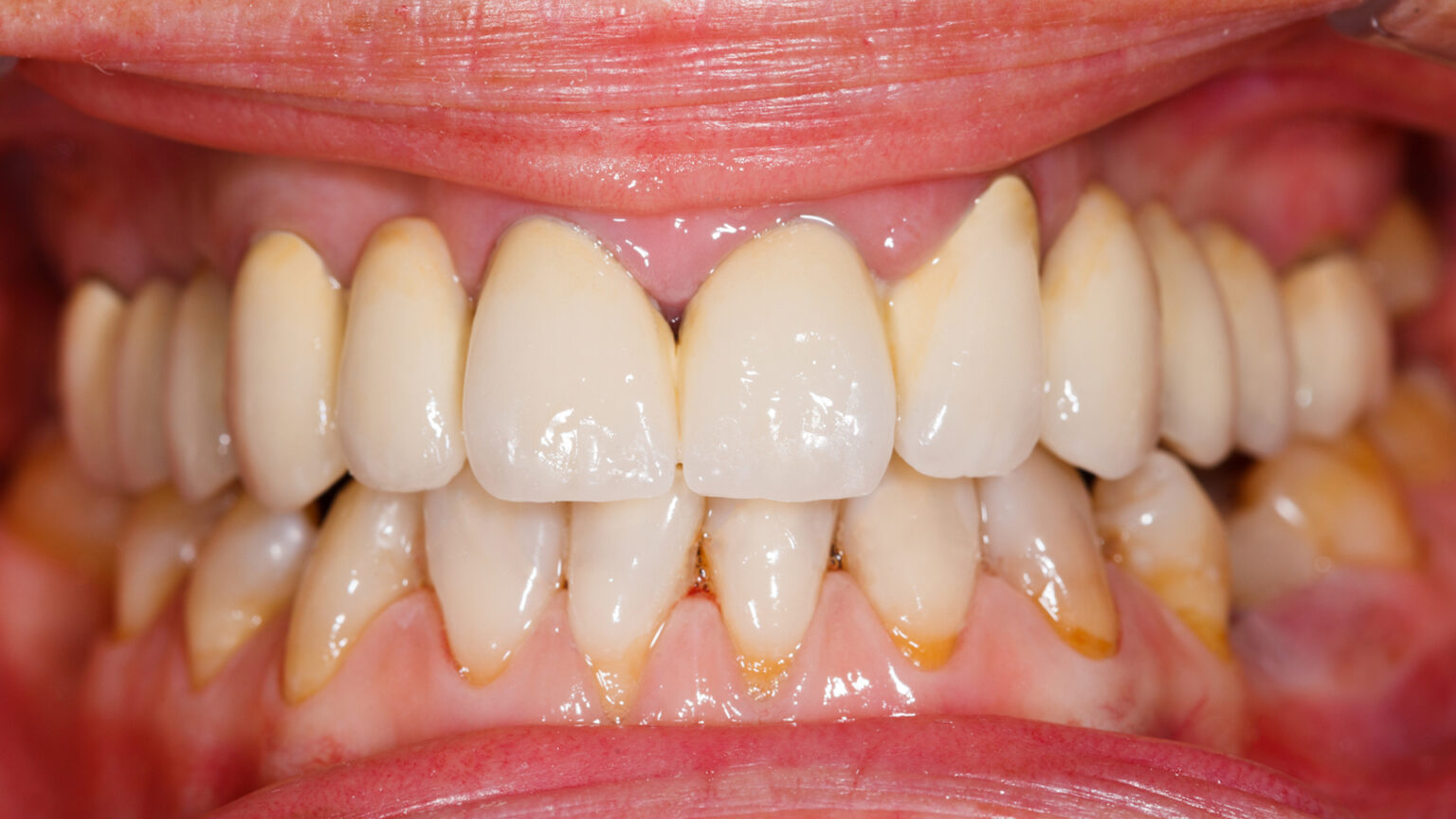 Greffe de gencive : prix, procédure et remboursement | Body Expert