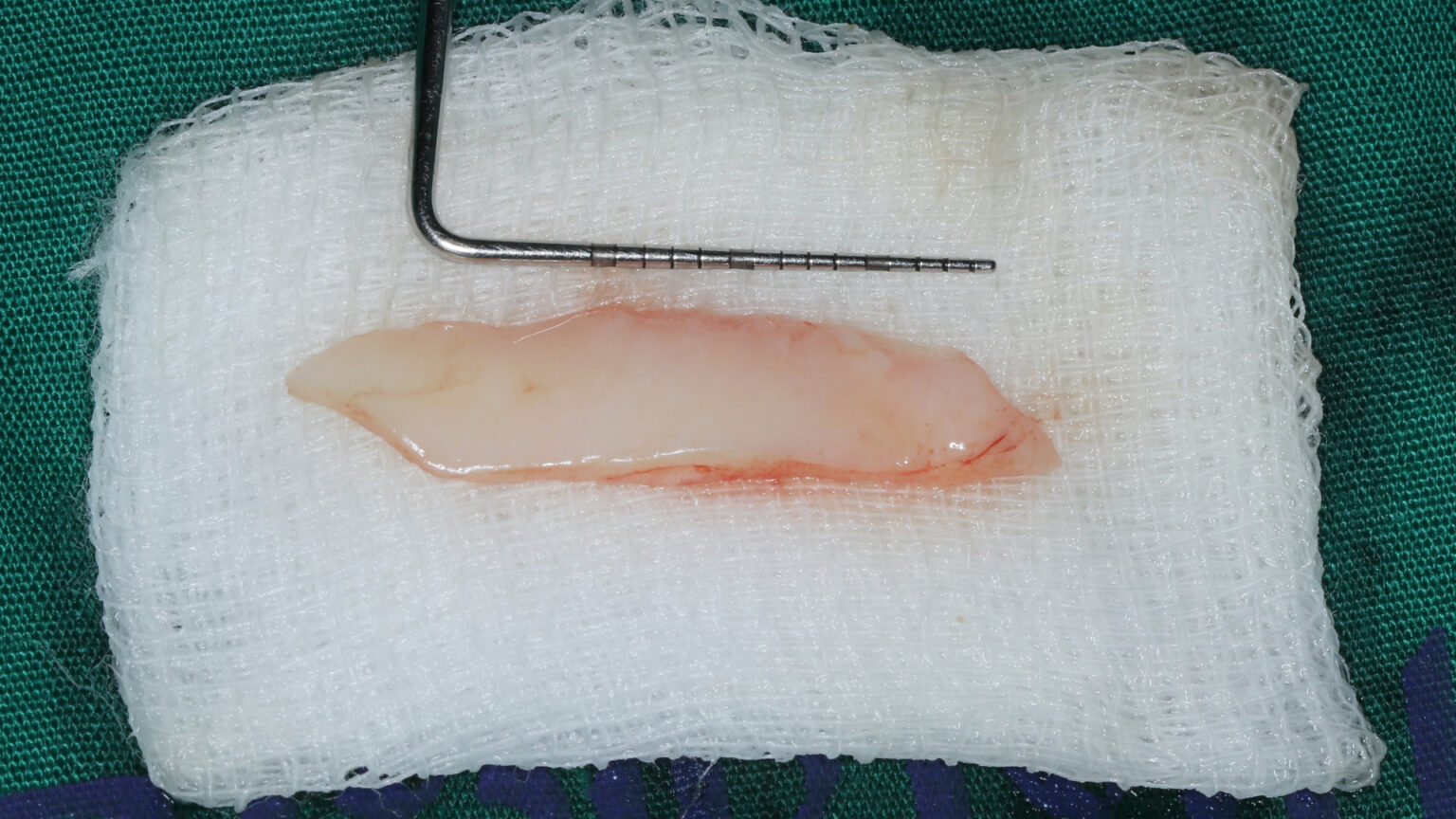 Greffe de gencive : prix, procédure et remboursement | Body Expert