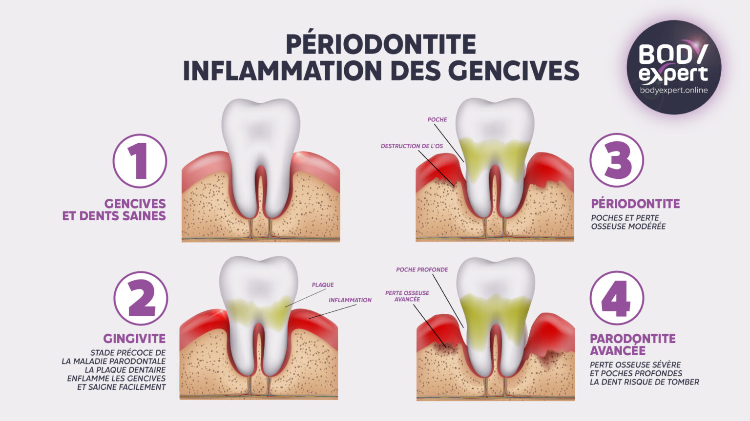 Parodontite stade terminal : diagnostic, traitements et prévention ...