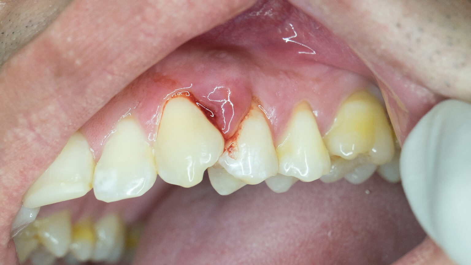 Severe Periodontal Disease: Diagnosis, Treatment and Prevention | Body ...