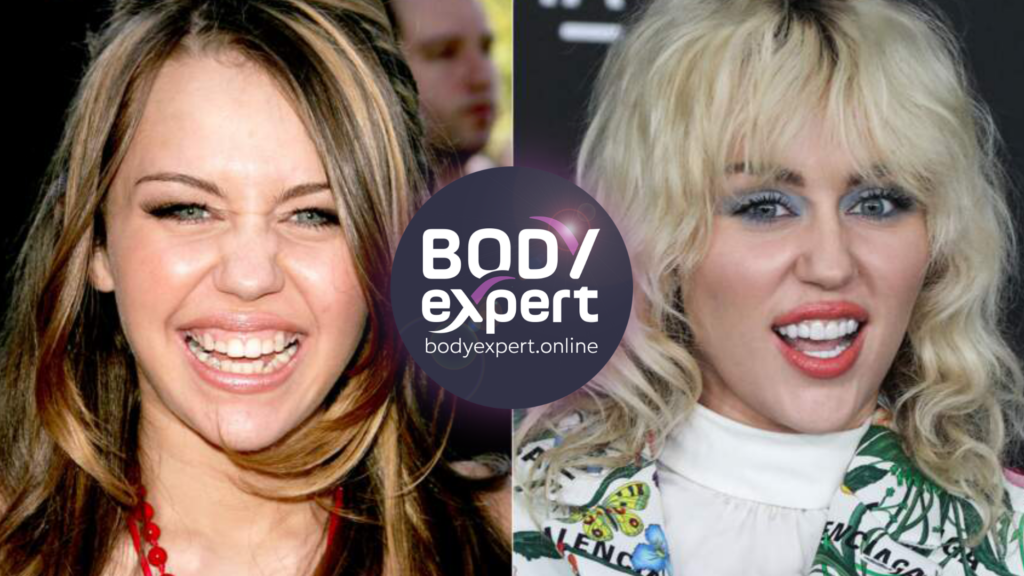 Celebrities with Veneers : the Hollywood Smile Rules