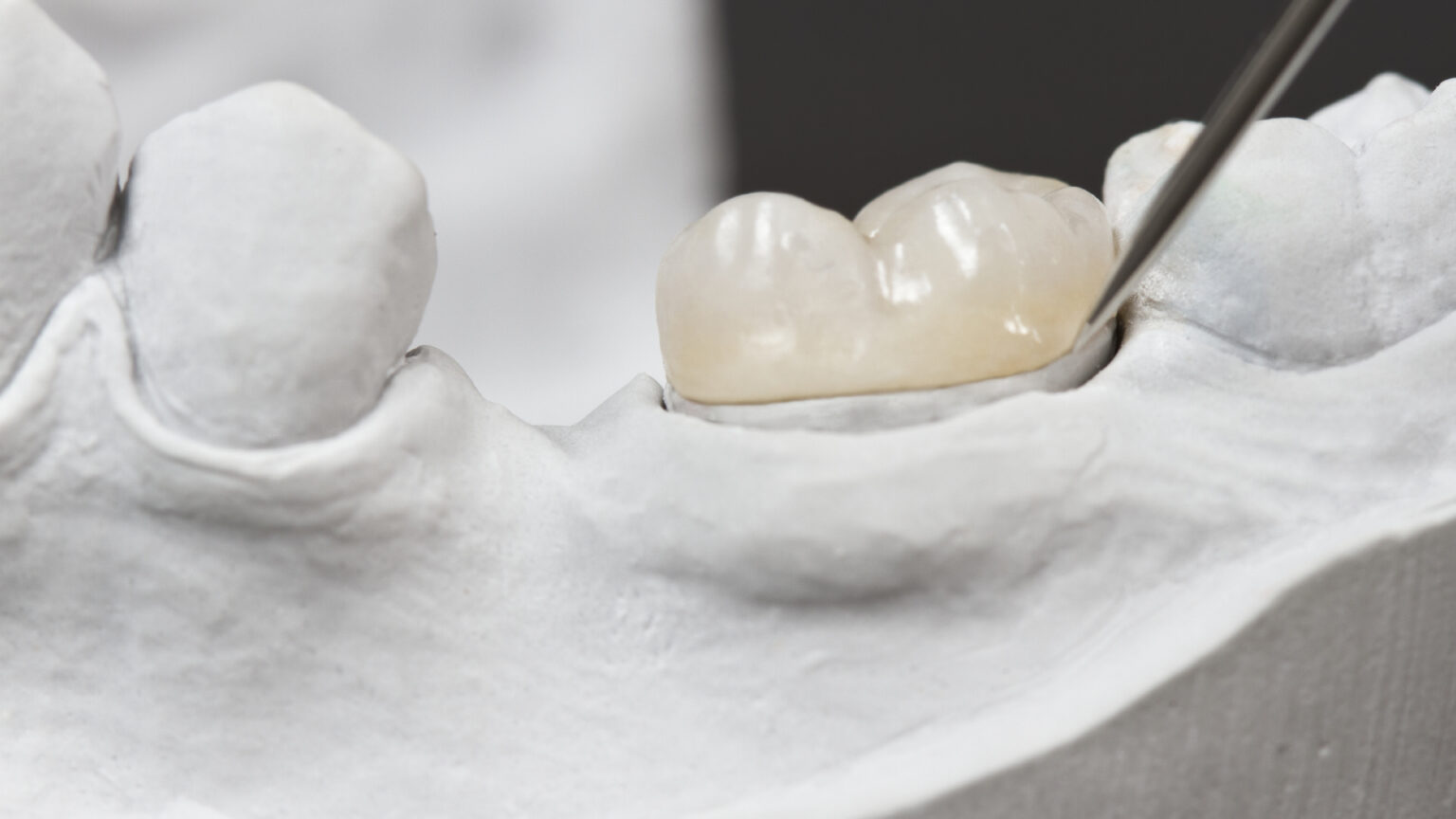 Inlay Onlay: Principles, Indications and Alternatives | Body Expert