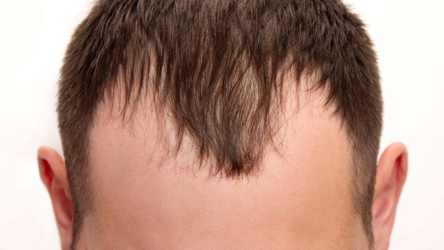 Receding Hairline & Temple Hair Loss: Causes, Stages and Effective ...