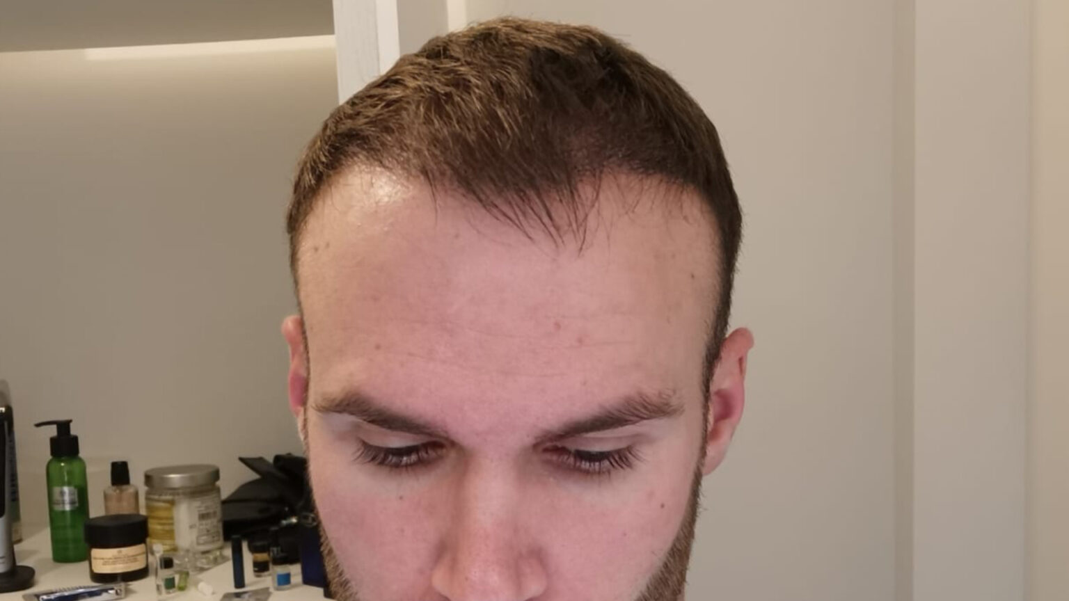 Receding Hairline & Temple Hair Loss: Causes, Stages and Effective ...