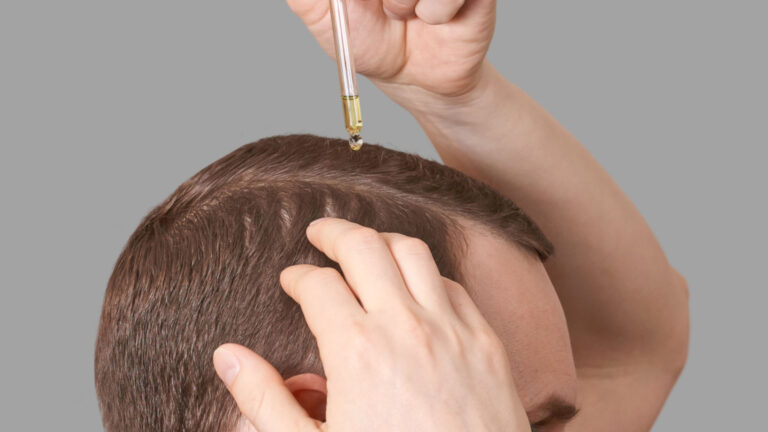 Receding Hairline & Temple Hair Loss: Causes, Stages and Effective ...