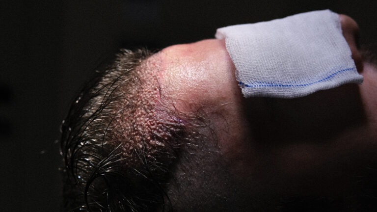 Receding Hairline & Temple Hair Loss: Causes, Stages and Effective ...