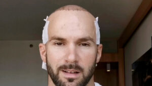 Receding Hairline & Temple Hair Loss: Causes, Stages and Effective ...