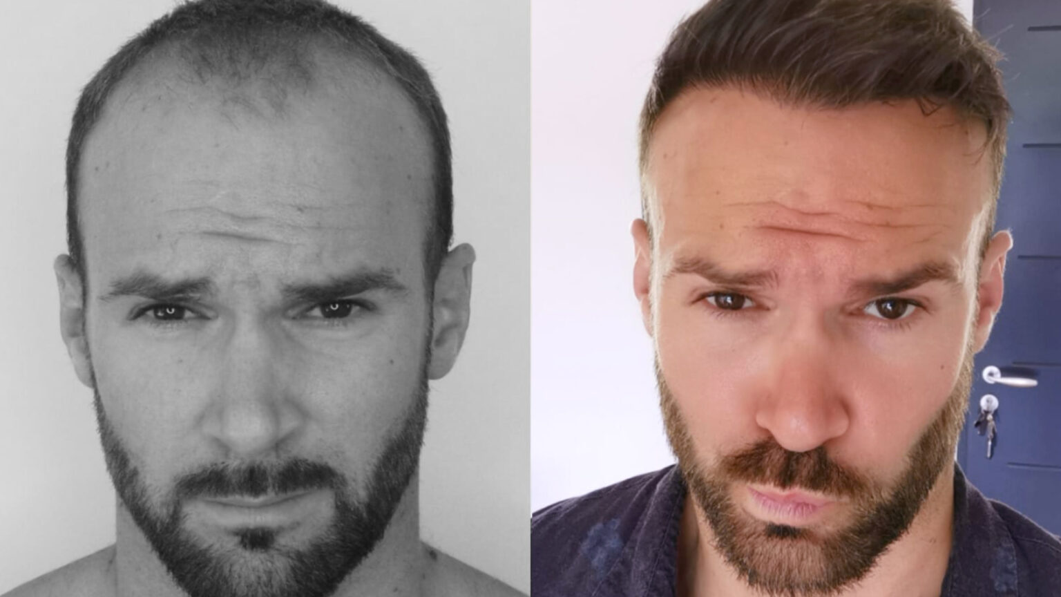 Receding Hairline & Temple Hair Loss: Causes, Stages and Effective ...